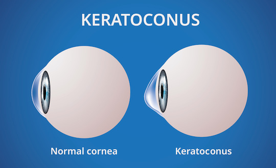 Understanding Keratoconus - Sexton Vision Group